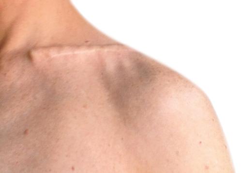 Operate or wait? A guide to collarbone injuries | Cycling UK